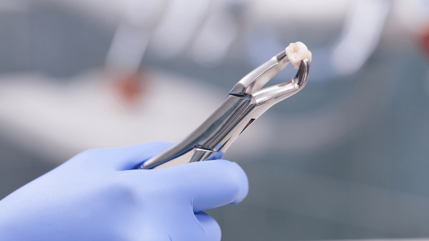 Tooth Extractions | Summit Oral Surgery & Implant Center